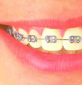 Brackets de Zafiro | Frenillos CR