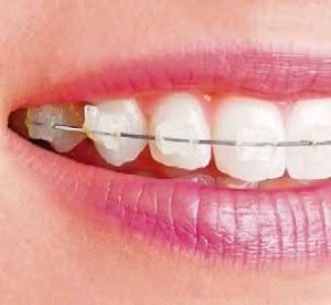 Flow Jac System | Frenillos CR