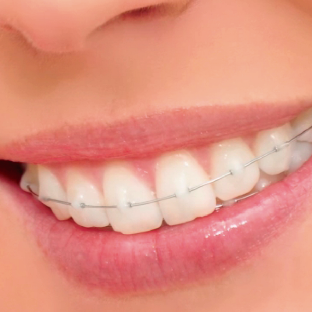 Flow Jac System | Frenillos CR